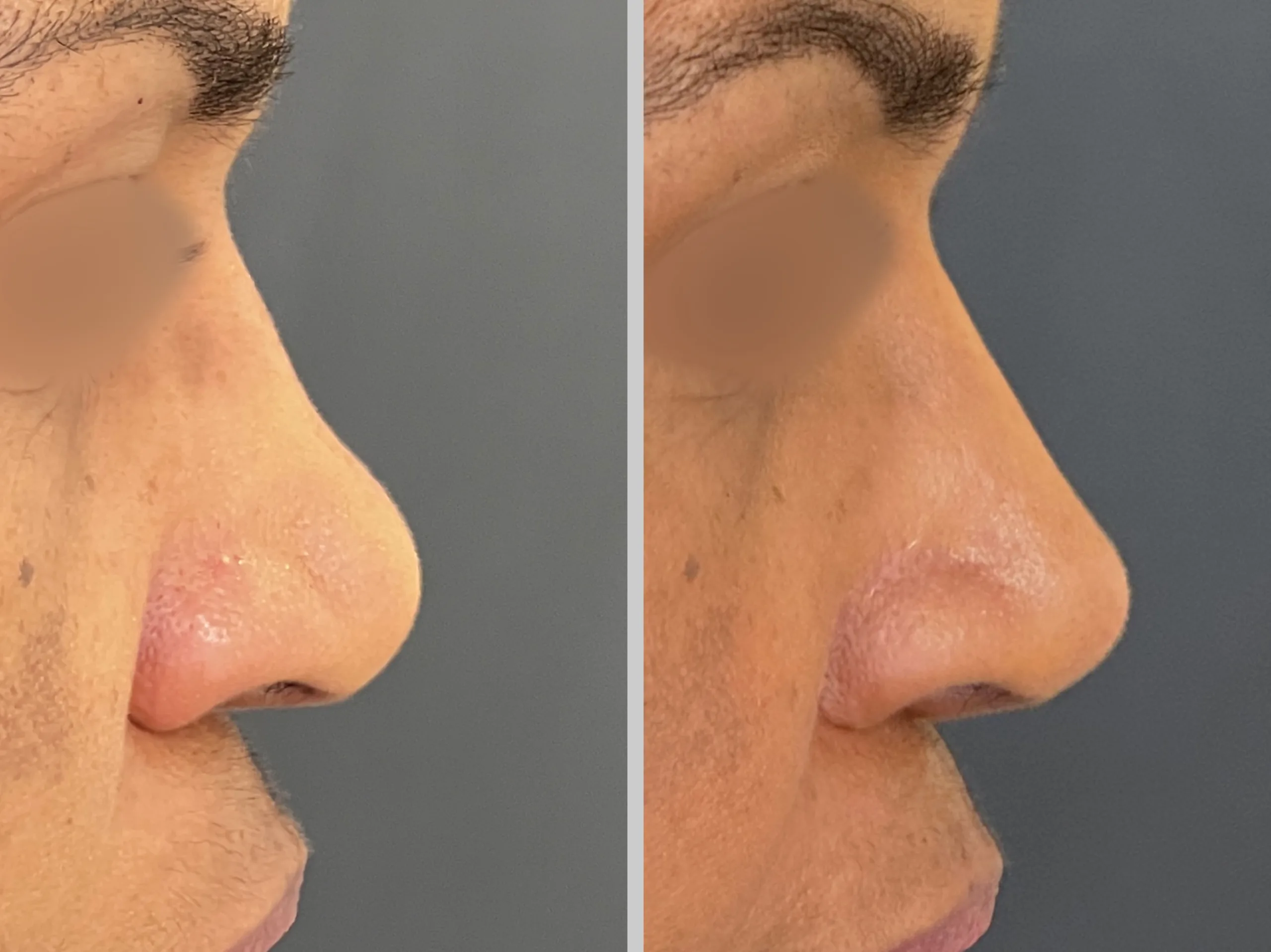 Rinoplastia Antes E Depois